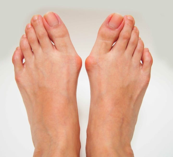 Fat Pad Restoration - Boynton Beach - Boca Raton Foot Care