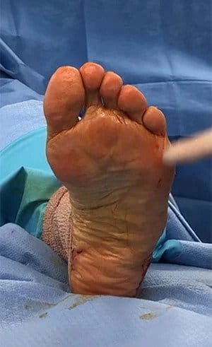 Fat Pad Restoration - Boynton Beach - Boca Raton Foot Care