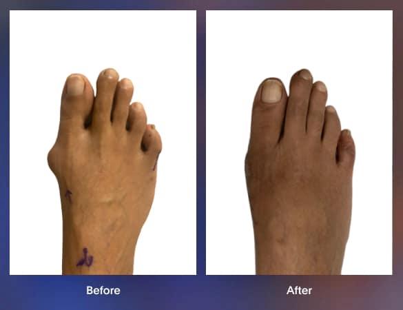 Lapiplasty - Boca Raton | Boynton Beach Foot Doctors